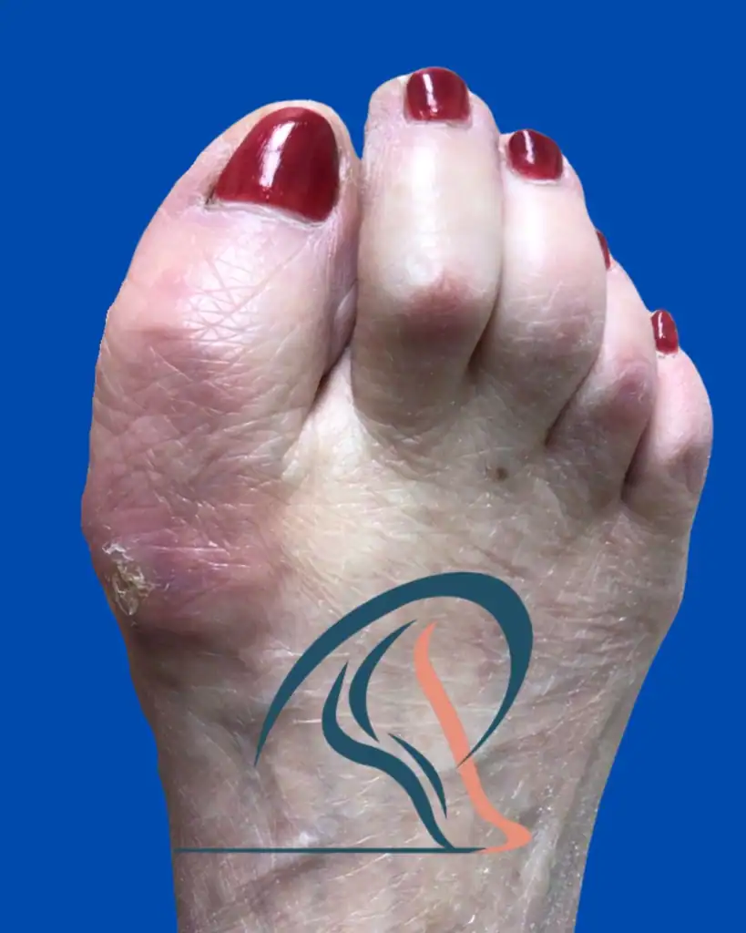 Before & After Gallery - Stride Forward Podiatry