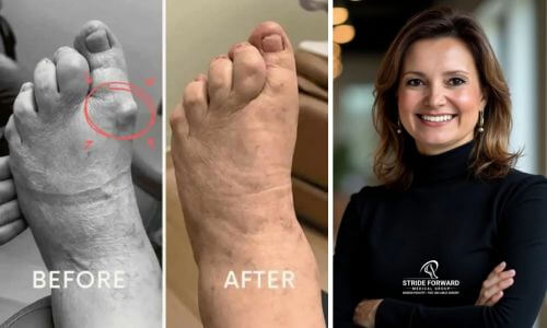 Preparing for Minimally Invasive Foot Surgery Guide