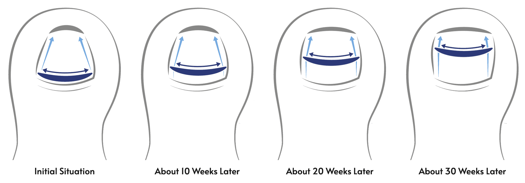 Onyfix Ingrown Toenail Treatment | Stride Forward Podiatry